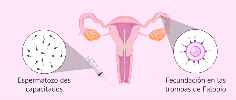 ¿Qué es la inseminación artificial intrauterina?