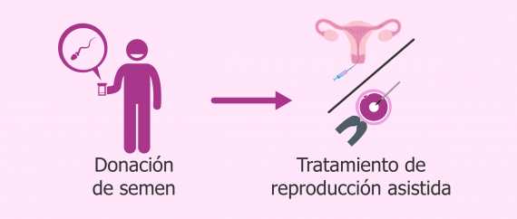 ¿En qué consiste la congelación de espermatozoides?
