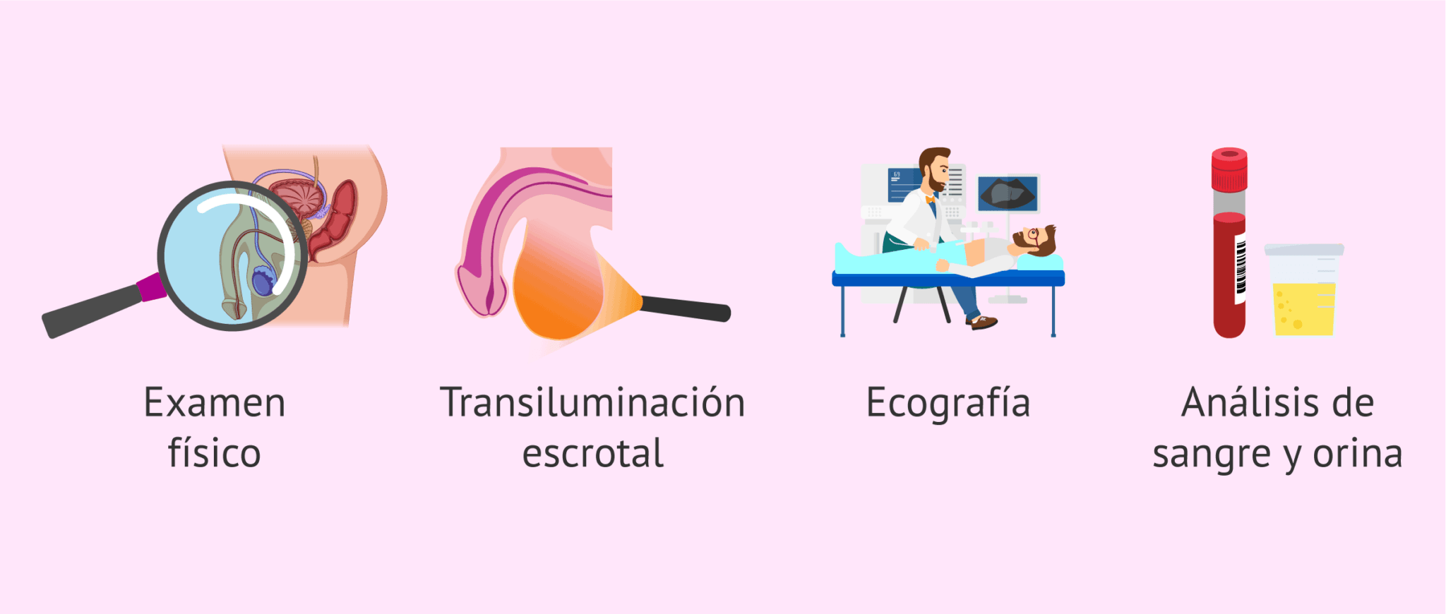 El hidrocele testicular: ¿qué es y cuáles son los síntomas?