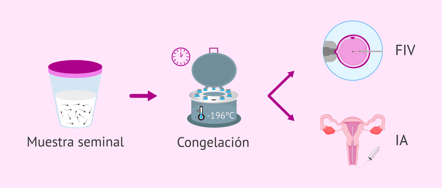 ¿En qué consiste la congelación de espermatozoides?