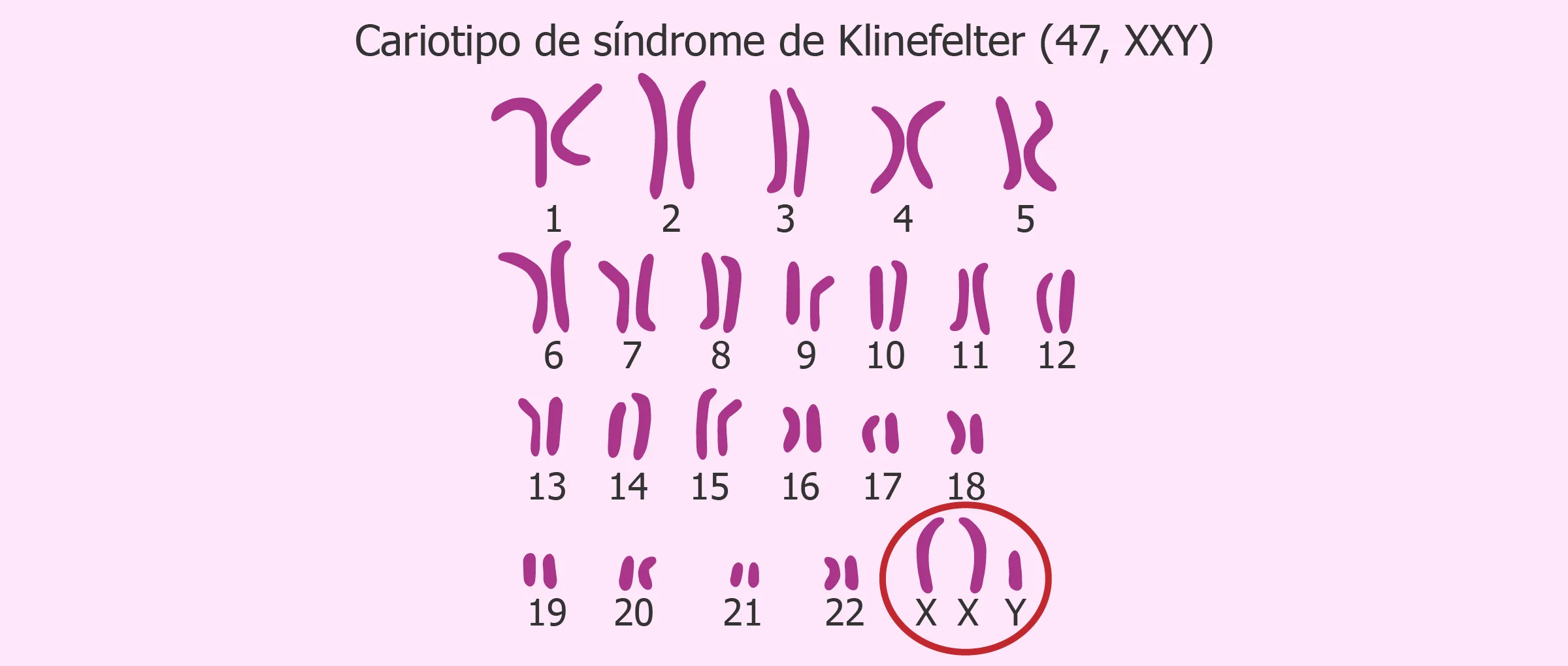 Sindrome De Klinefelters Klinefelter Syndrome In Female