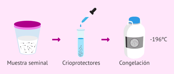 ¿En qué consiste la congelación de espermatozoides?